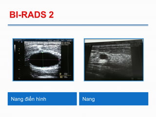 Bai 27 b sieu am vu birads | PDF