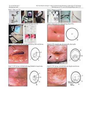 QUẢN LÝ TIẾT DỊCH ÂM ĐẠO BẤT THƯỜNG VÀ PHẾT MỎNG CỔ TỬ CUNG BẤT THƯỜNG BIỂU HIỆN QUA SOI CTC CỦA ...