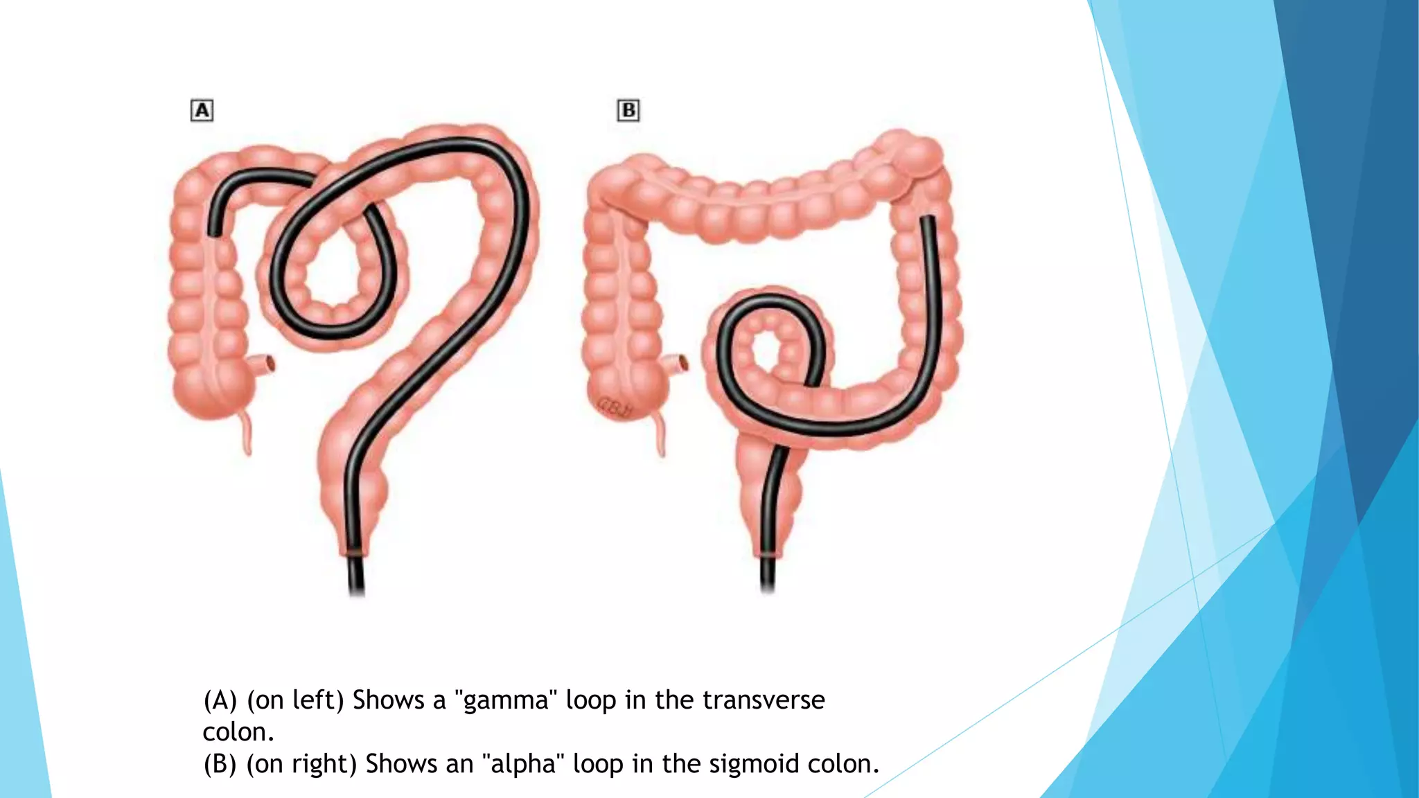 baiscs of colonoscopy.pptx