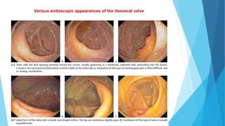 baiscs of colonoscopy.pptx
