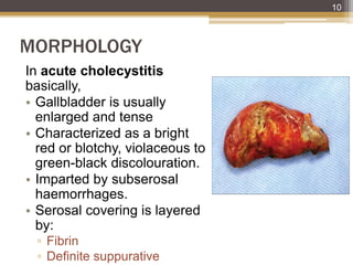Acute Cholecystitis Gross