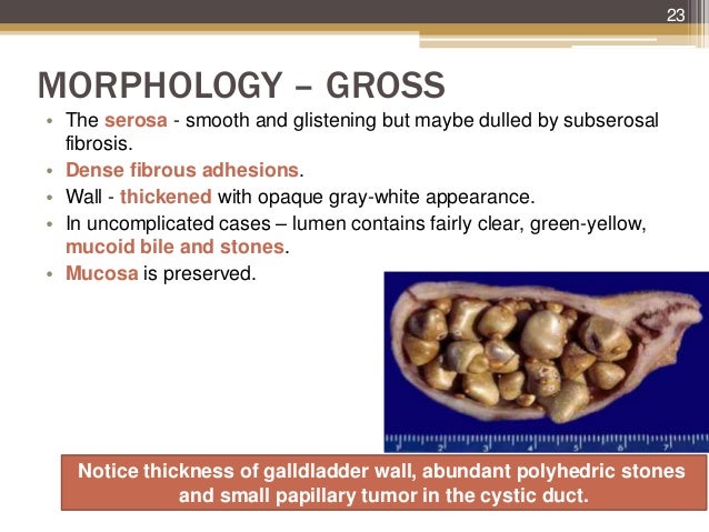 Chronic Cholecystitis Gross