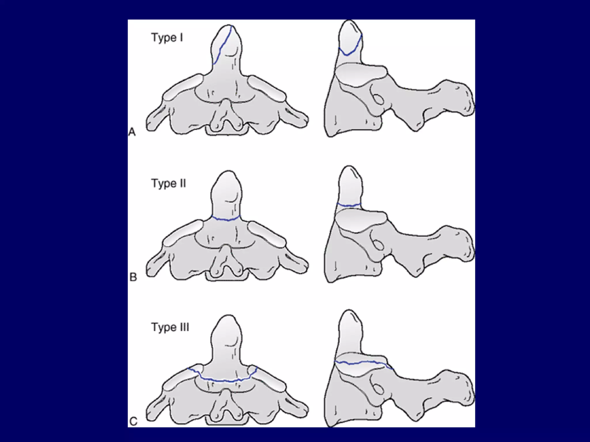 Bajammal 2006 Upper Cervical Trauma | PPT