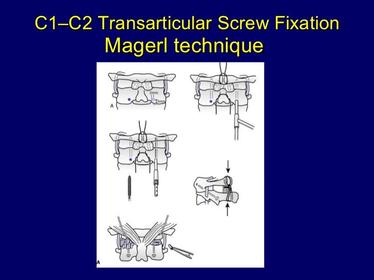 Bajammal 2006 Upper Cervical Trauma