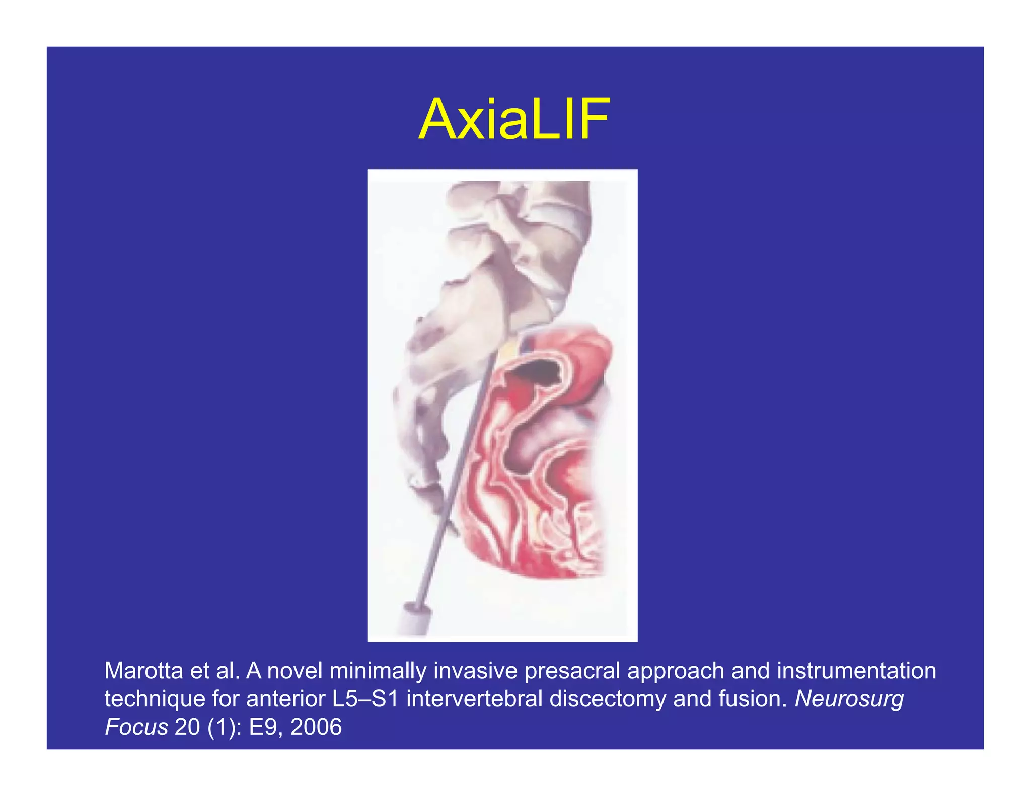 Adult Degenerative Scoliosis 2008 | PDF