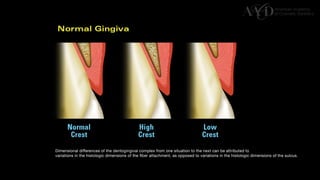 The Myths vs. Realities: Considerations in Esthetic Crown Lengthening | PDF