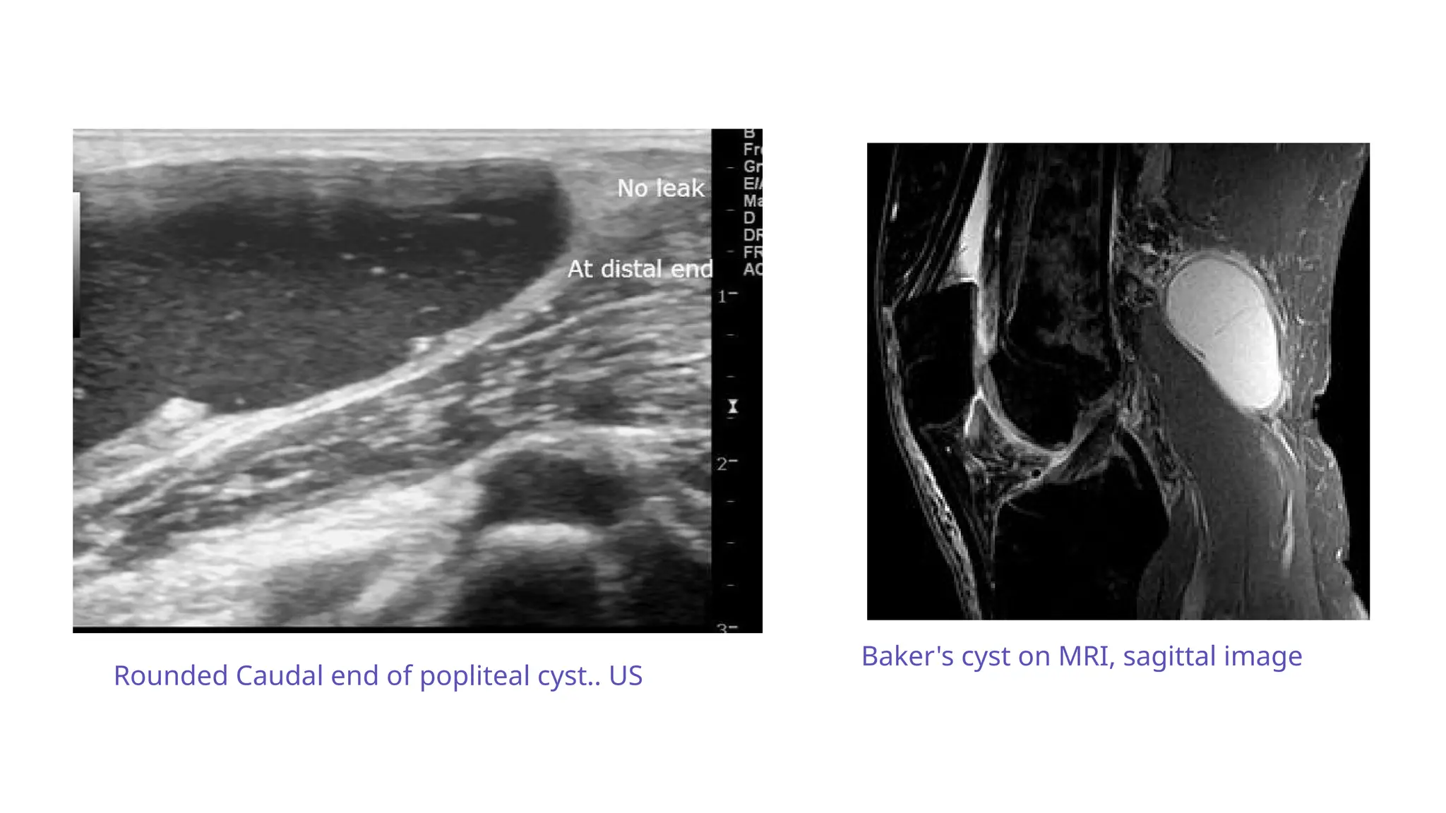 All about Baker Cyst and posterior knee pain.pptx