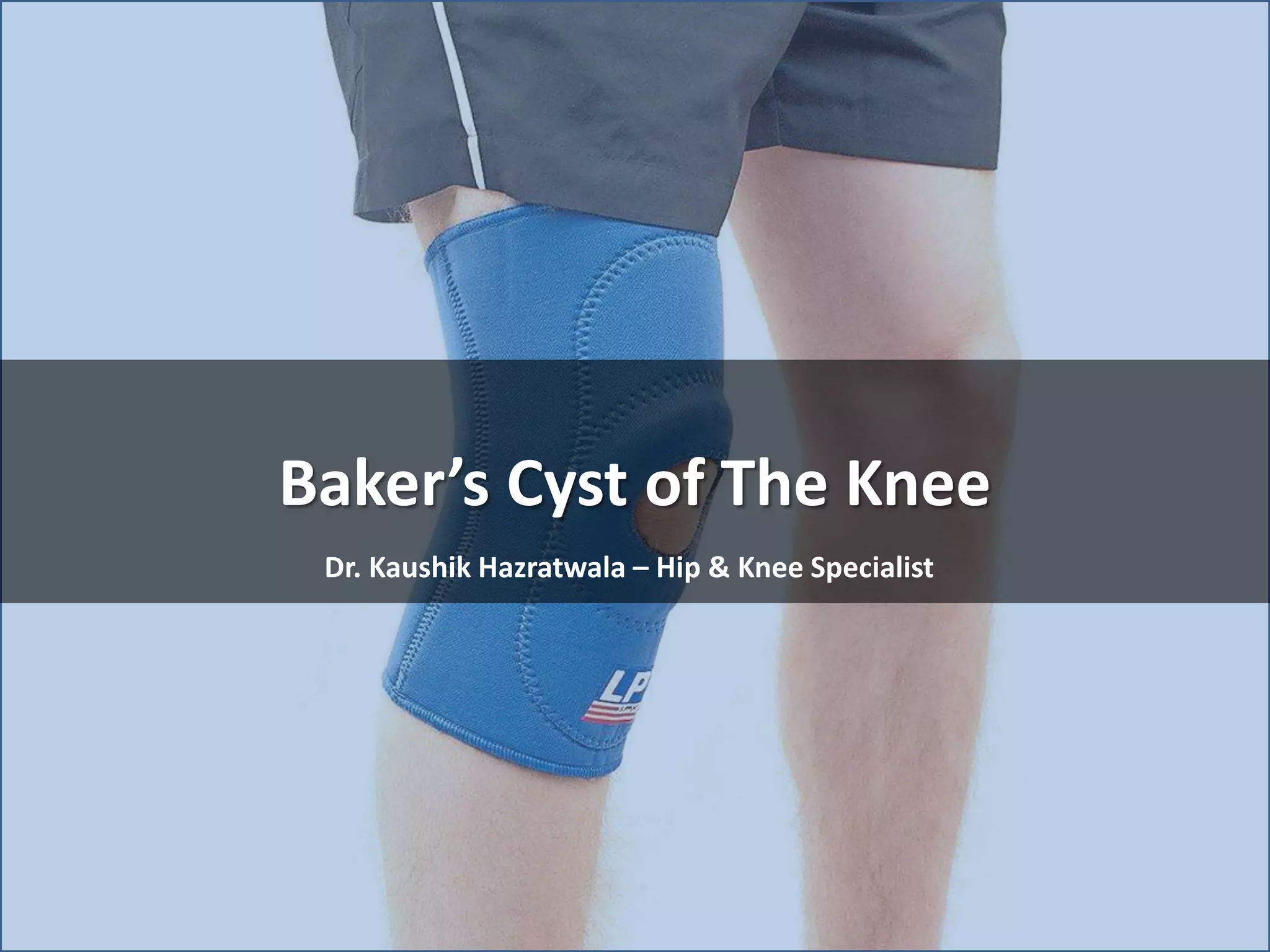 Bakers Cyst of The Knee | PPTX