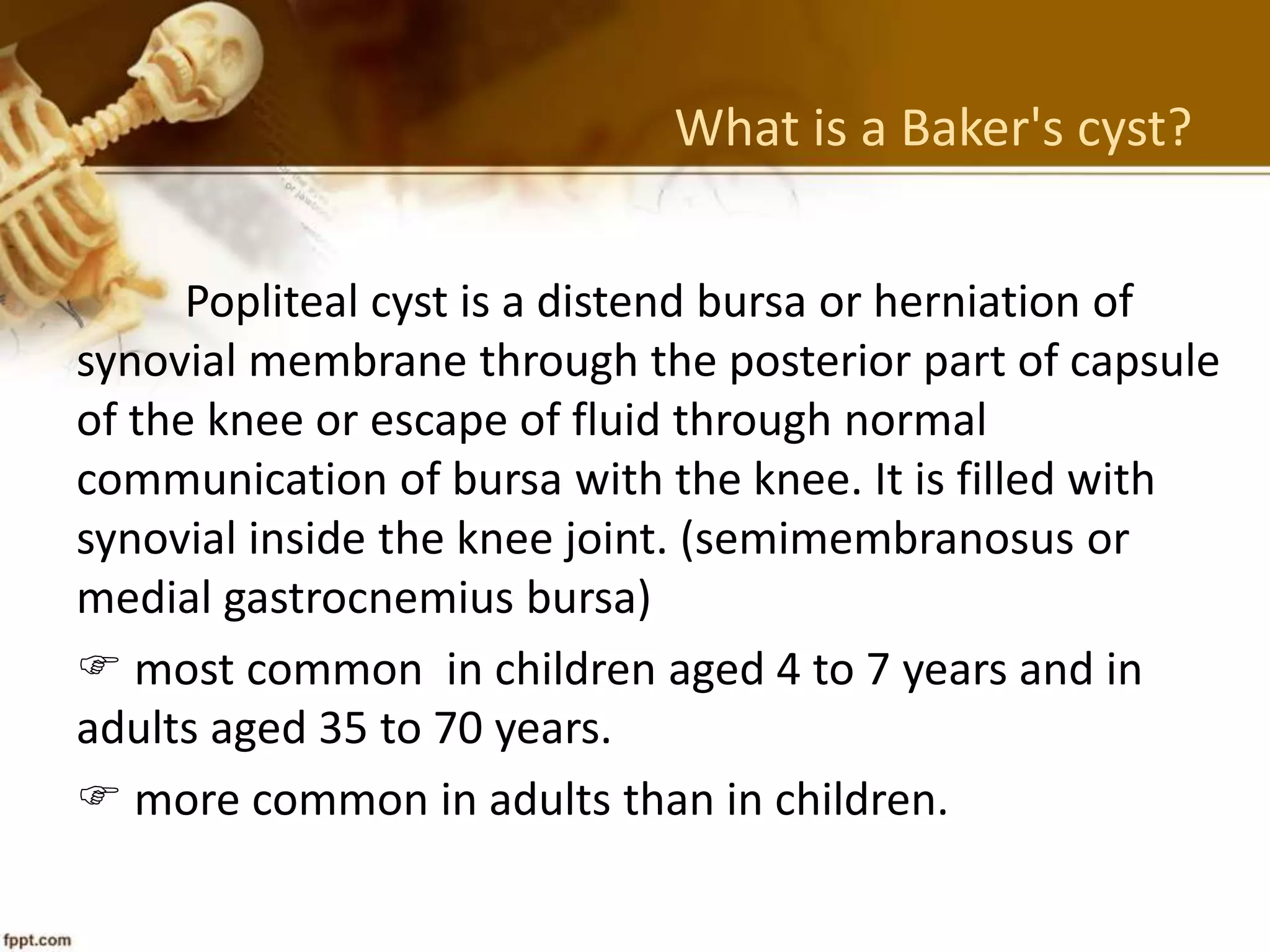 Baker's cyst | PPTX