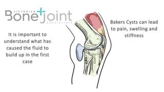 Bakers cyst | PPTX