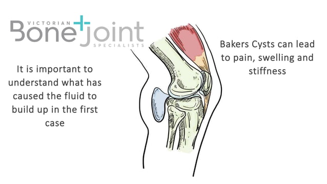 Bakers cyst | PPT