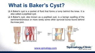 Bakers cyst symptoms, causes, diagnosis, & treatment | PPT