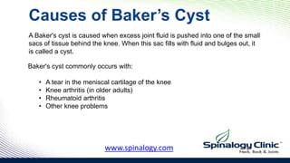 Bakers cyst symptoms, causes, diagnosis, & treatment | PPT