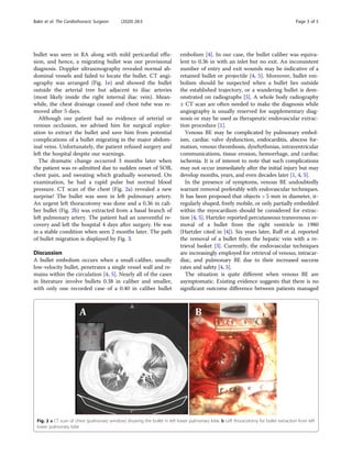 pulmonary_bullet embolism | PDF