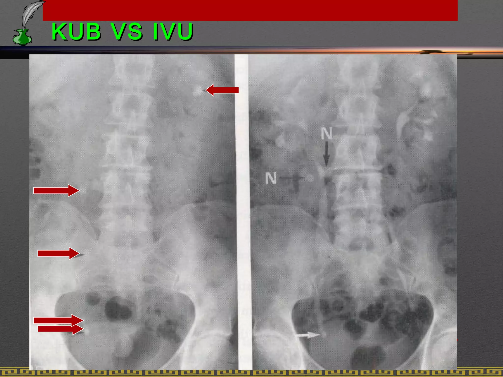 BAKTERIOLOGI & RADIOLOGI - SISTEM URINARI | PPT