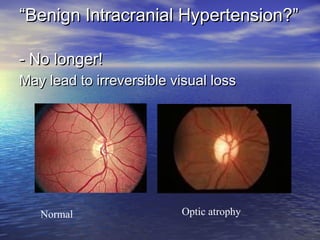 Idiopathic Intracranial Hypertension | PPT