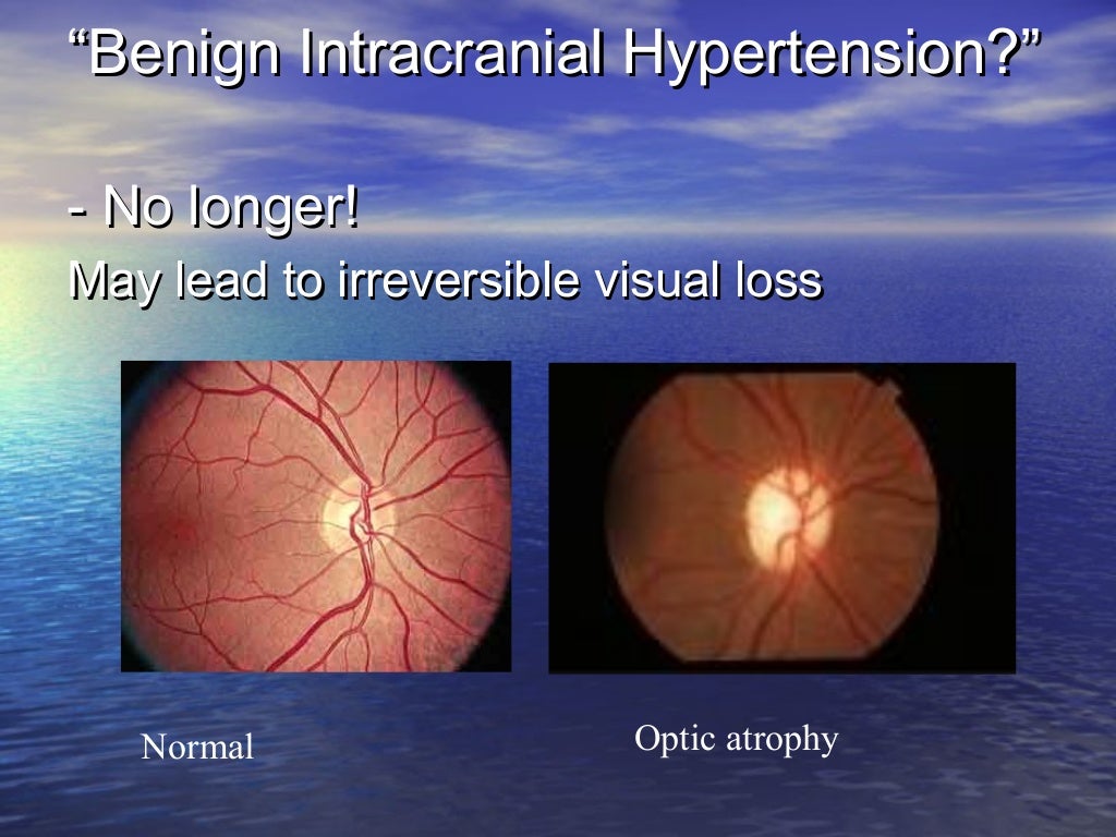 Idiopathic Intracranial Hypertension