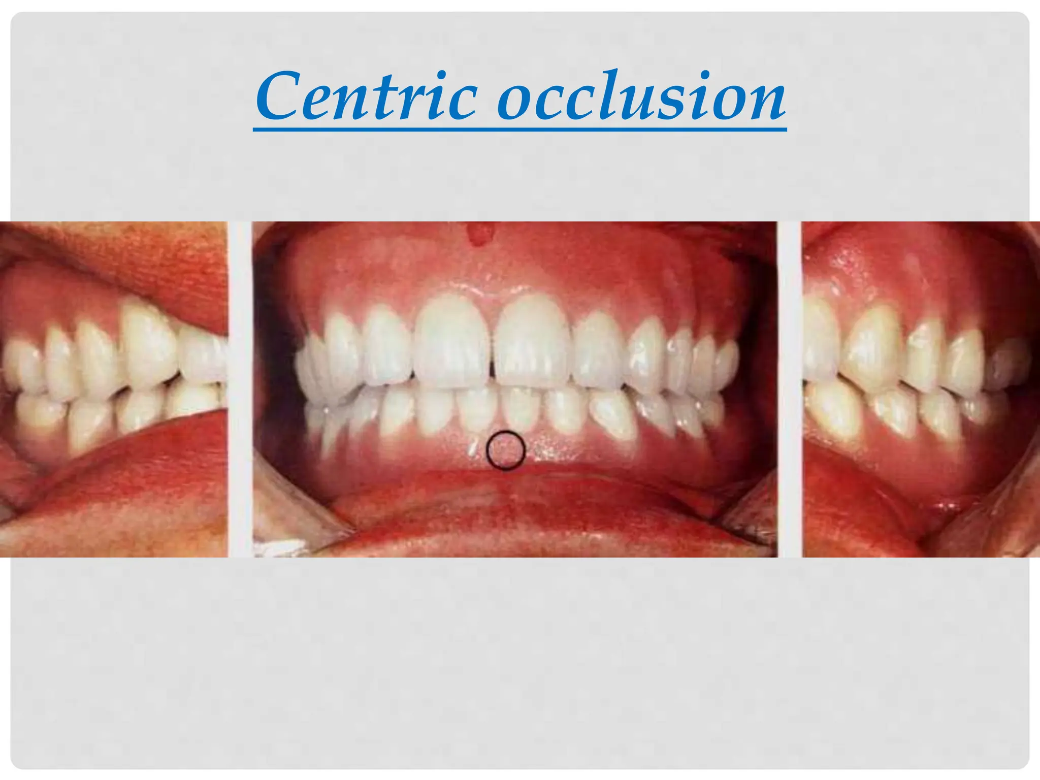 BALANCED OCCLUSION.pptx