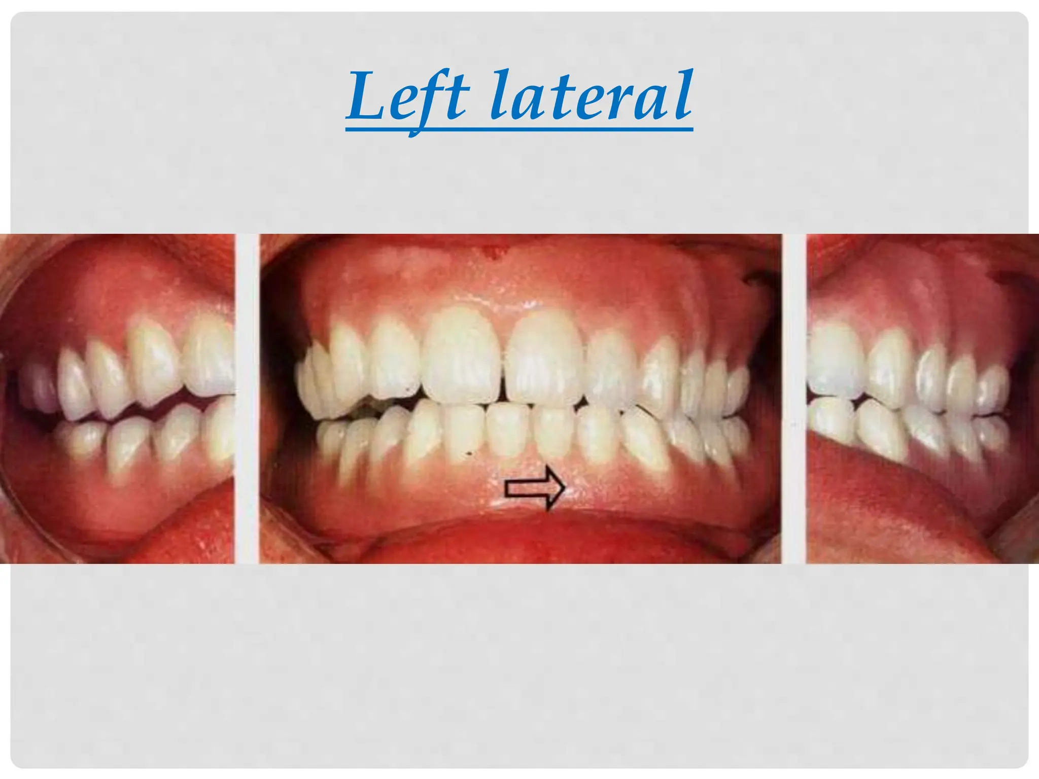 BALANCED OCCLUSION.pptx