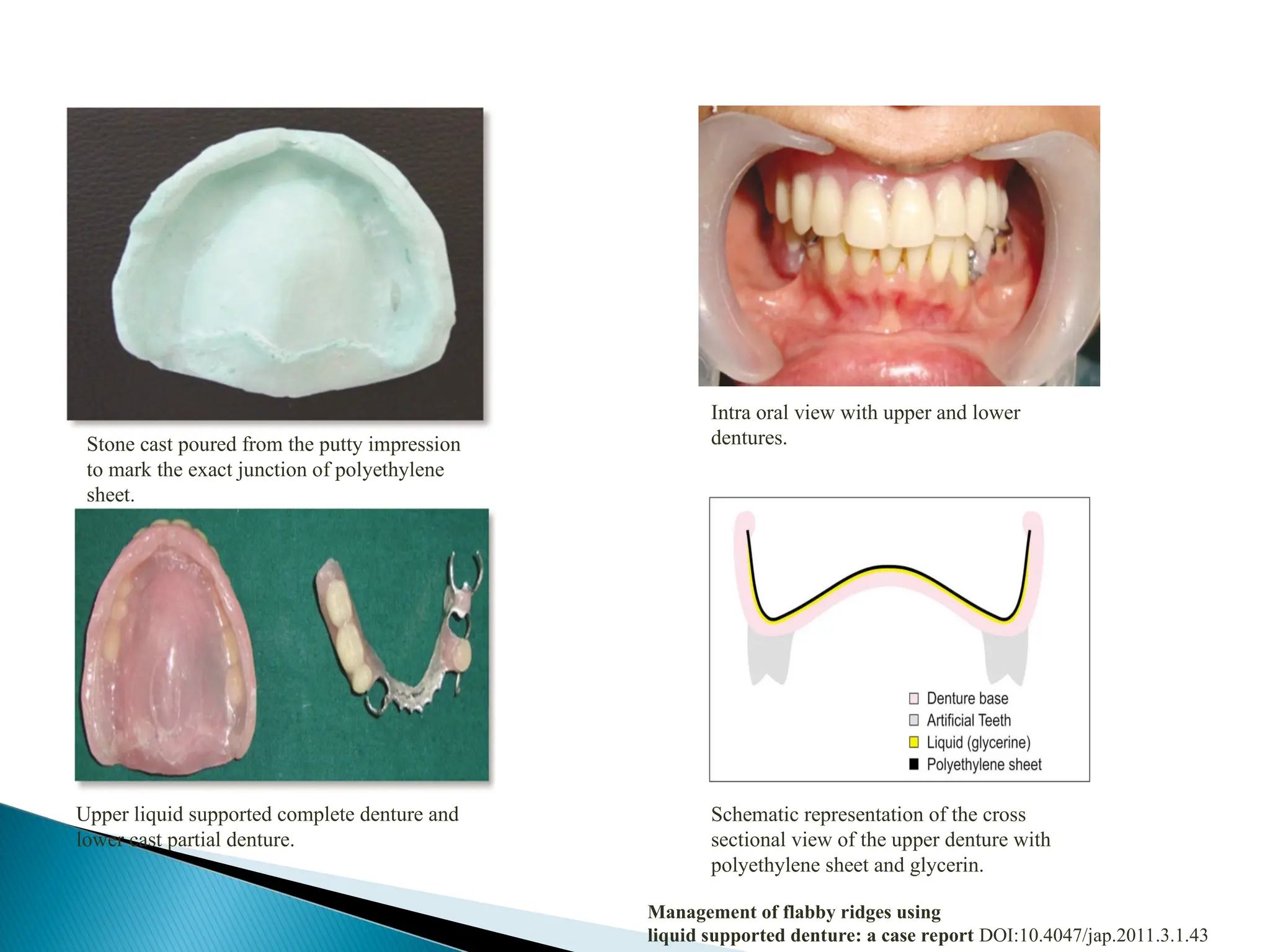 balancedocclusion in prosthodontics dentistry | PPT