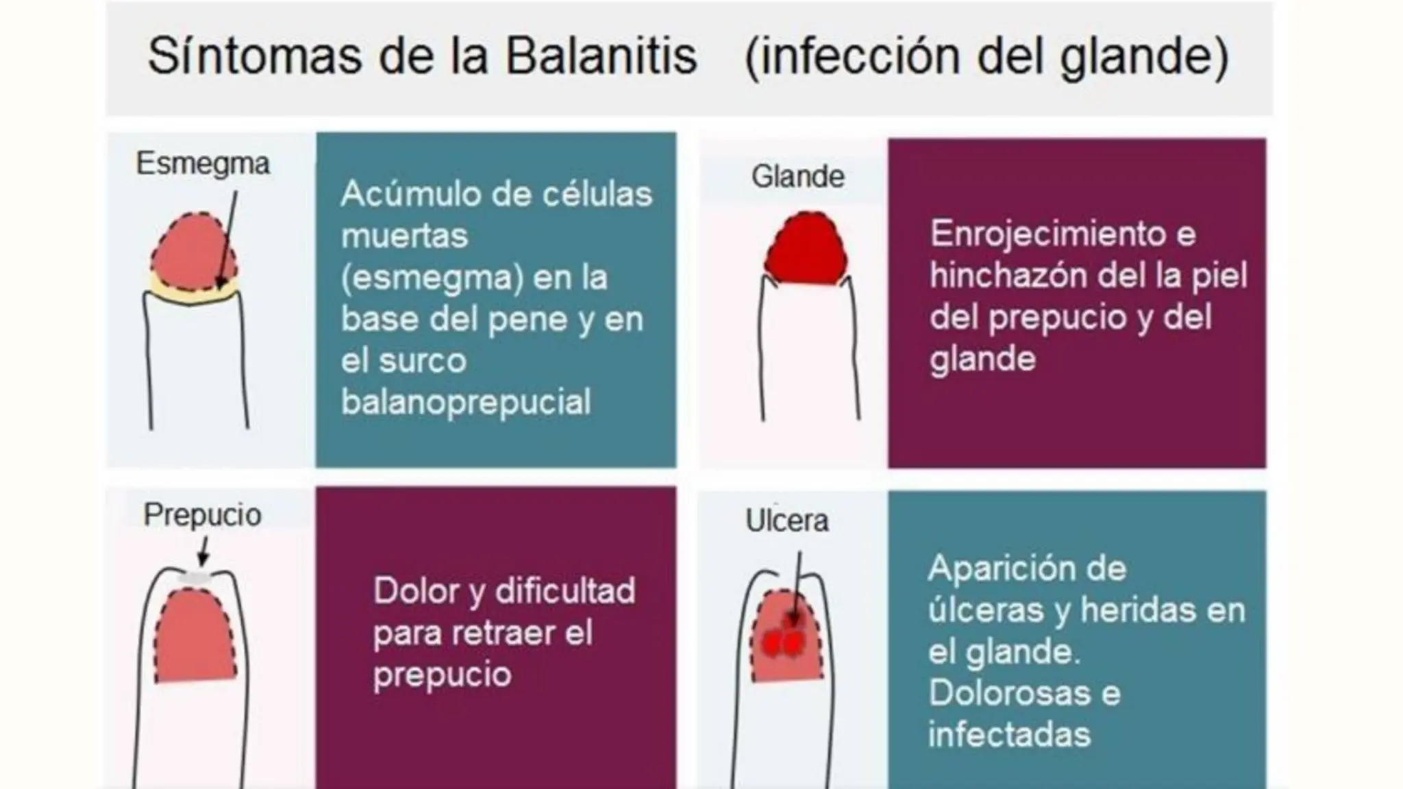 Balanitis patología, su etiología, factores de riesgo y tratamientos | PPTX