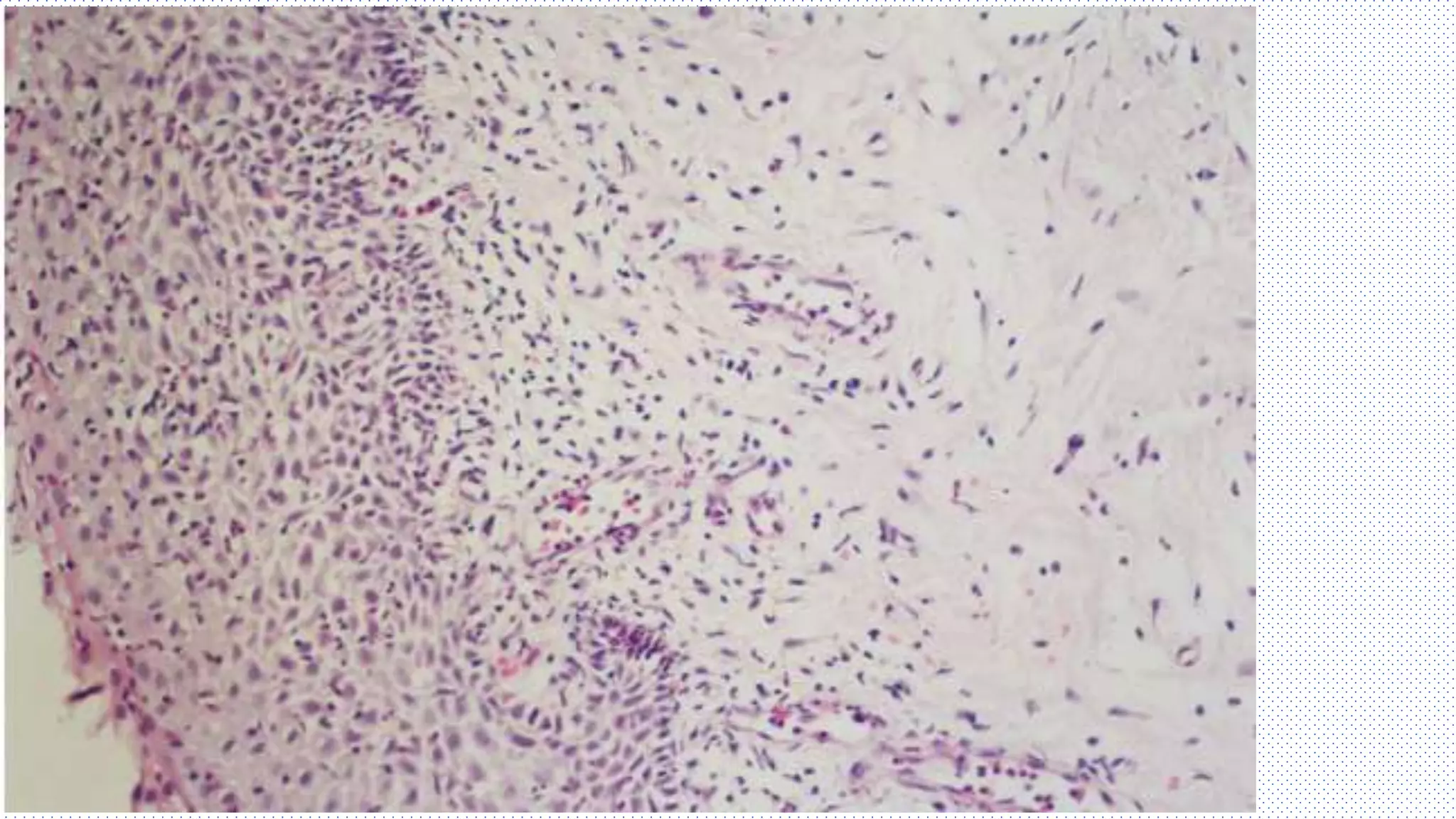 Balanitis de células plasmáticas de zoon.pptx