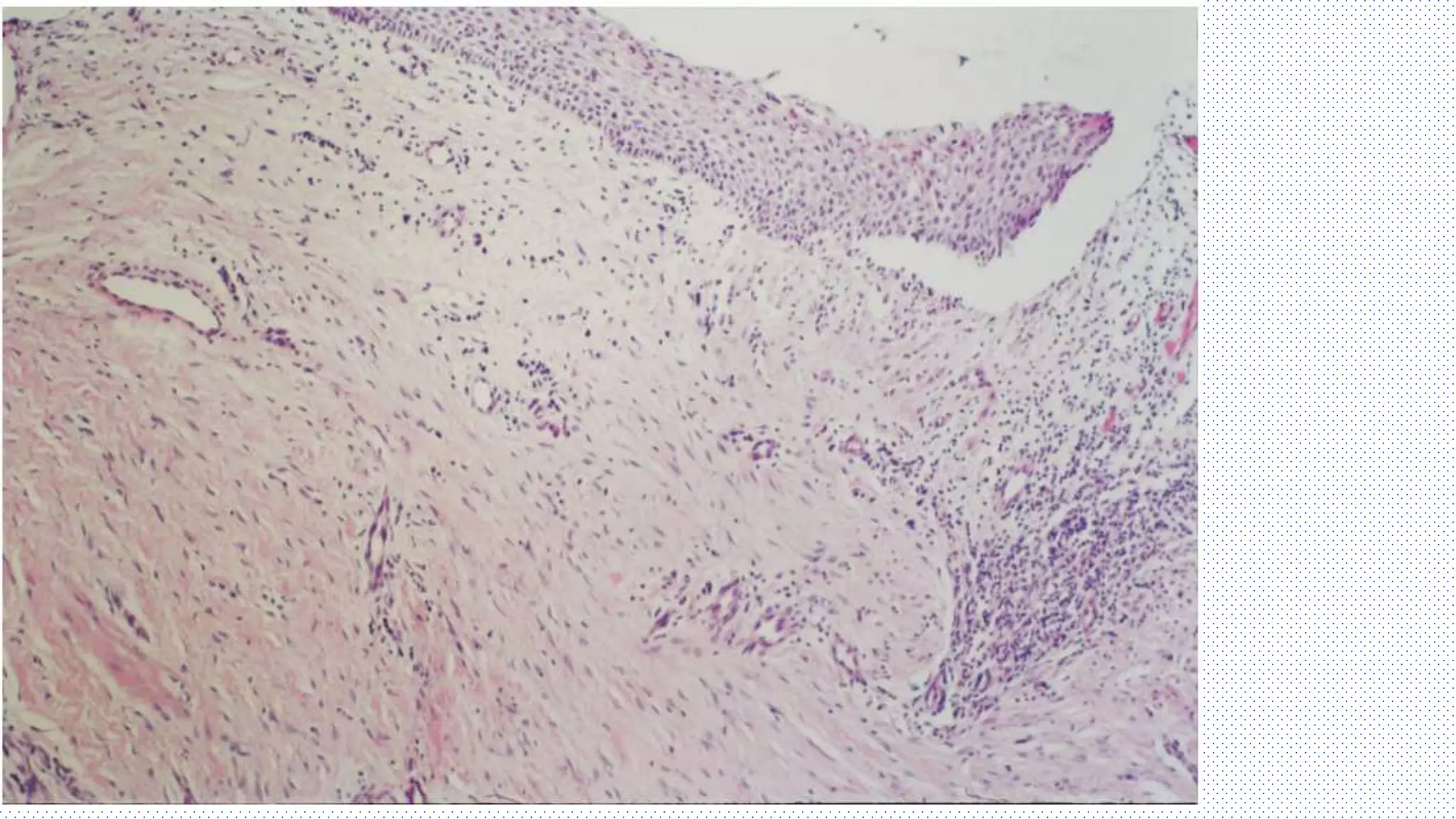 Balanitis de células plasmáticas de zoon.pptx