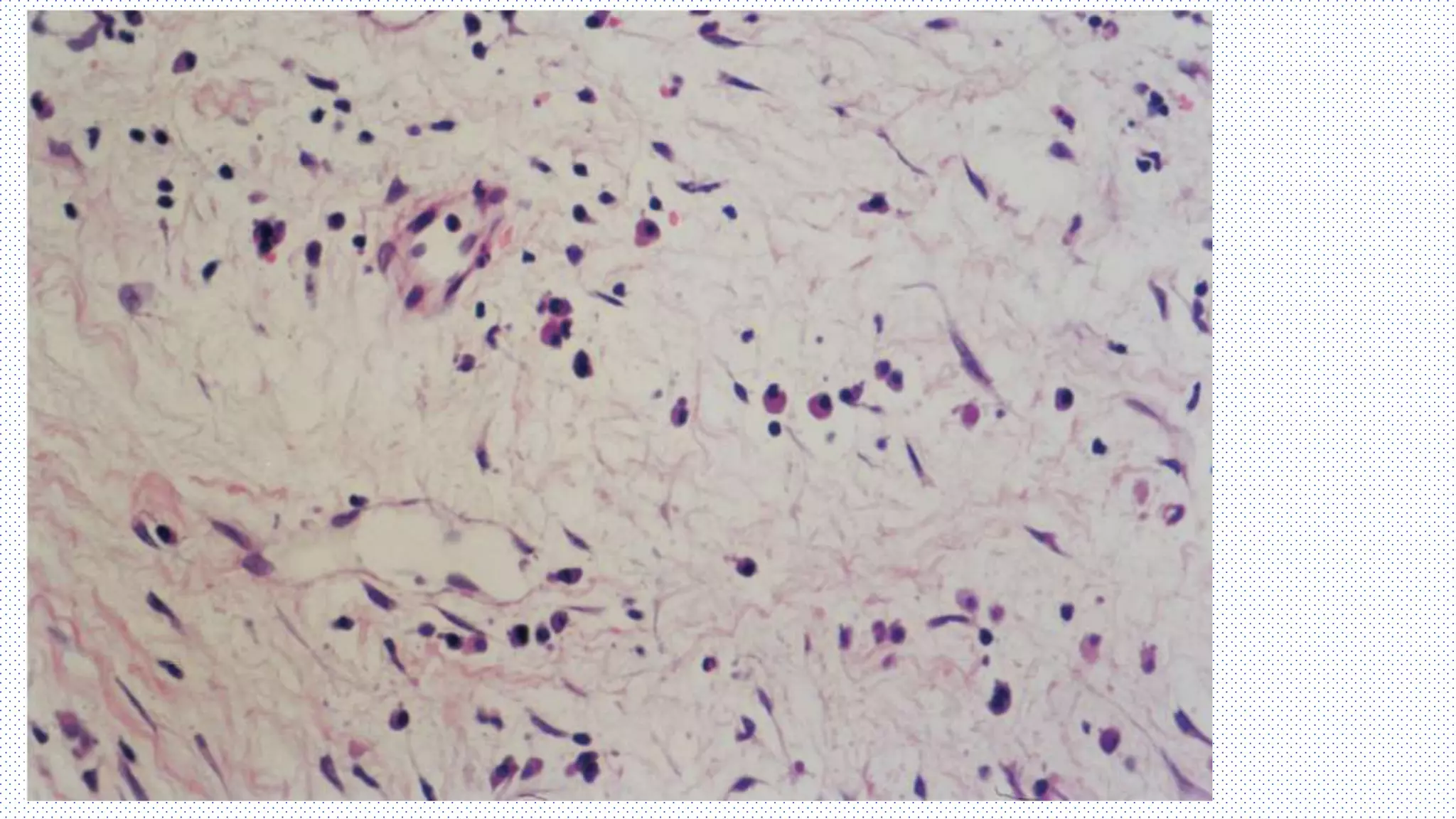 Balanitis de células plasmáticas de zoon.pptx