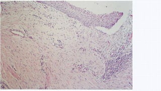 Balanitis de células plasmáticas de zoon.pptx