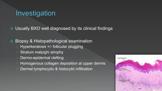 Balanitis Xerotica Obliterans (BXO) / Penile Lichen Sclerosus | PPTX ...
