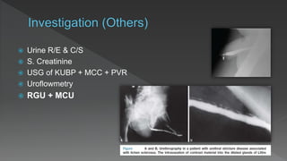 Balanitis Xerotica Obliterans (BXO) / Penile Lichen Sclerosus | PPTX ...