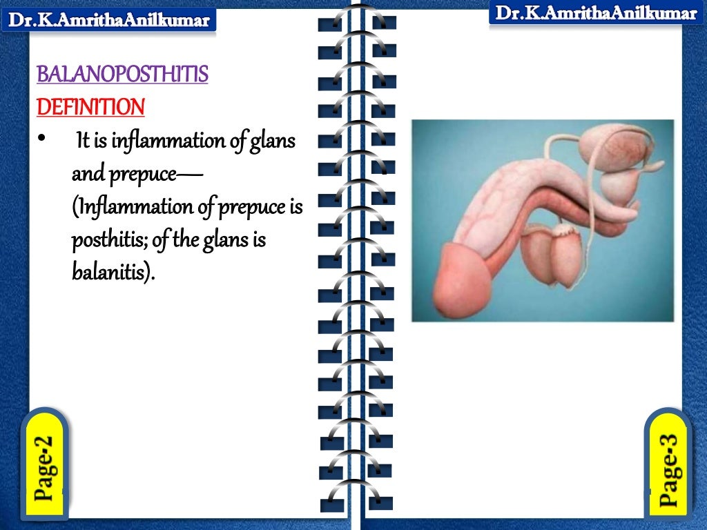 Balanosposthitis by Dr.K.AmrithaAnilkumar