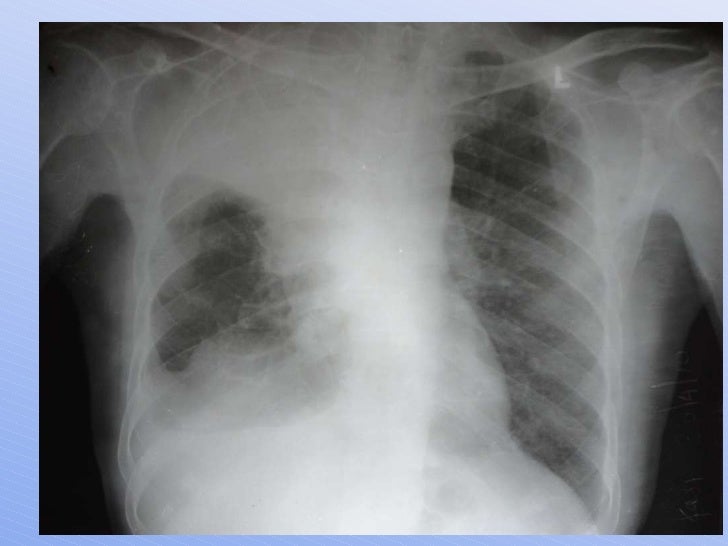 Lung Cancer Chest X Ray Wikidoc
