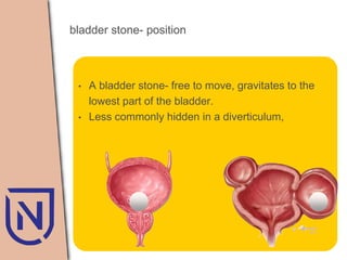 Baldder calculi neo | PPTX