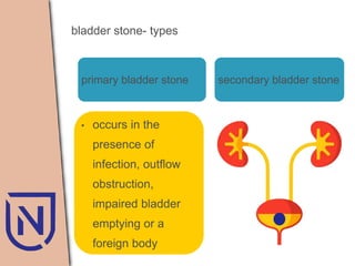Baldder calculi neo | PPTX