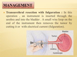 Baldder cancer (Bladder carcinoma) | PPT