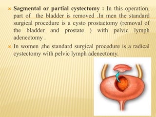 Baldder cancer (Bladder carcinoma) | PPT