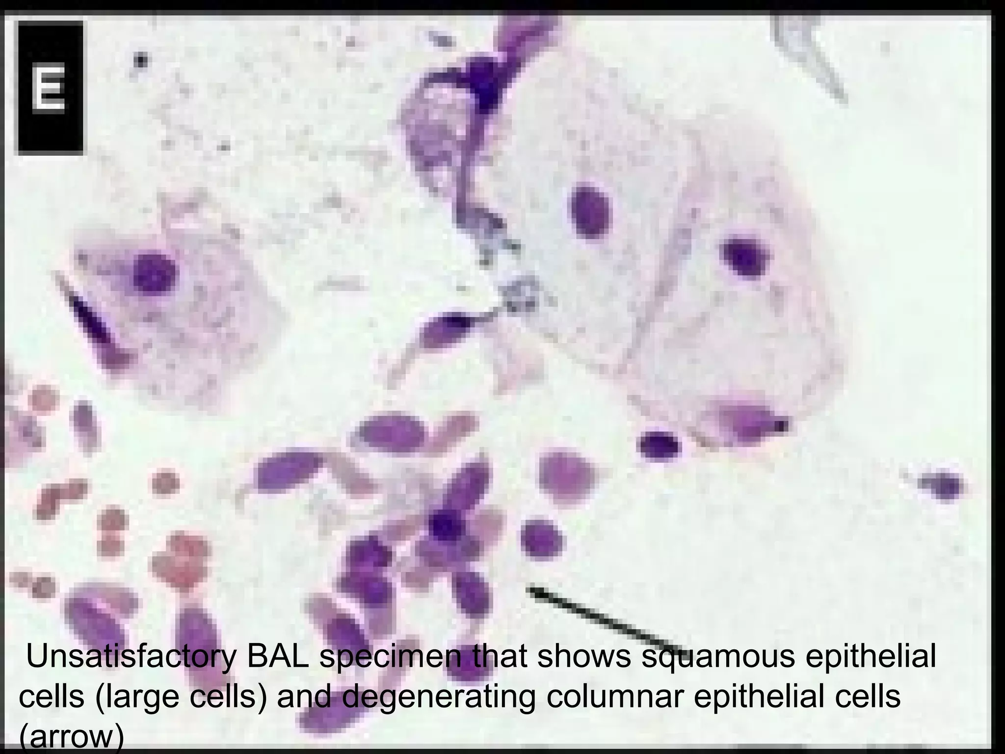 Bal fluid analysis | PPT