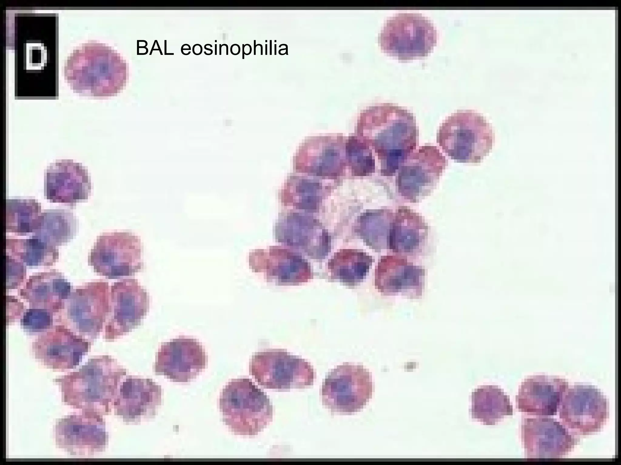 Bal fluid analysis | PPT