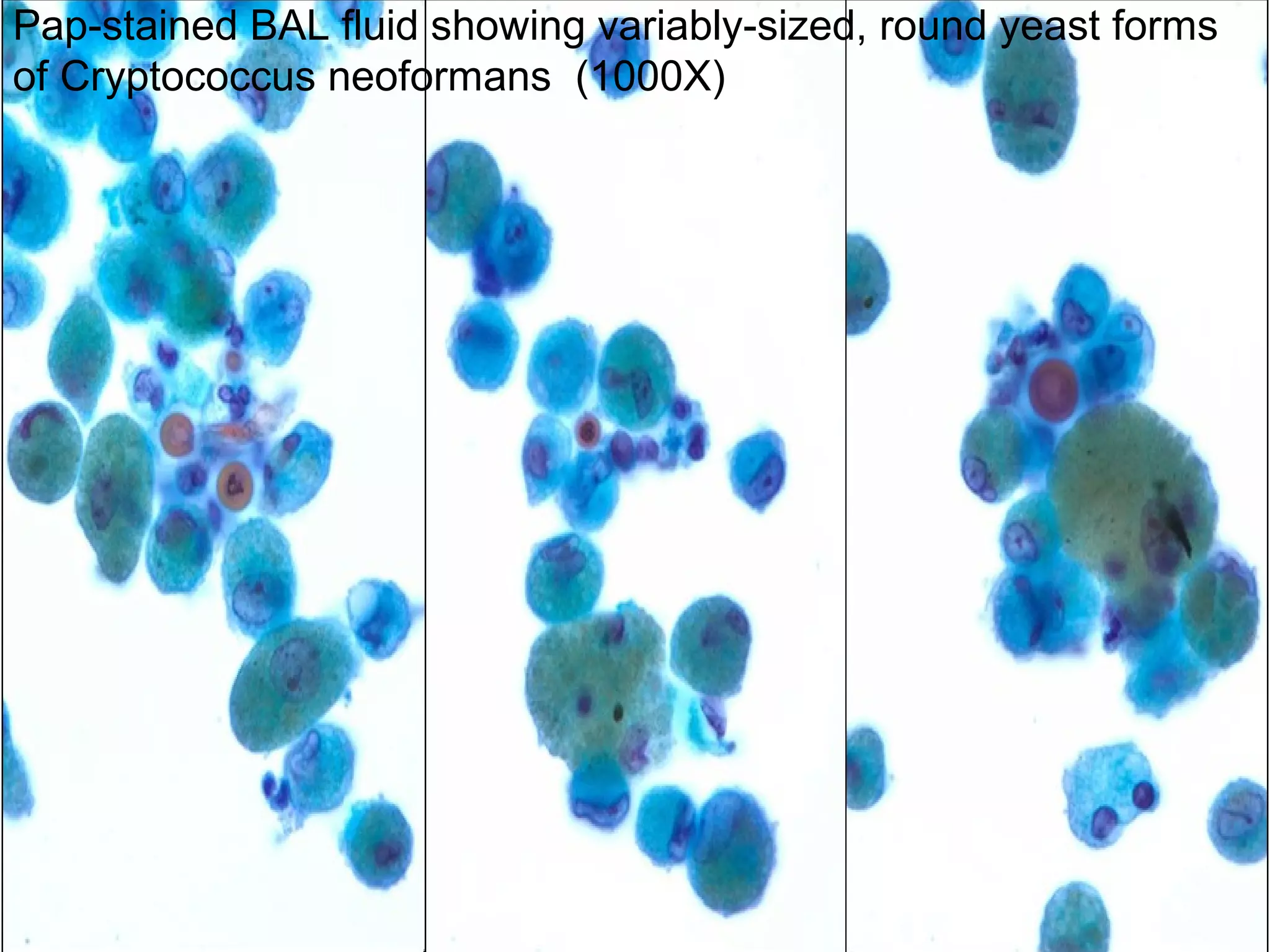 Bal fluid analysis | PPT