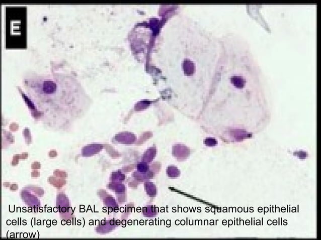 Bal fluid analysis | PPT | Lung and Respiratory Health | Diseases and ...