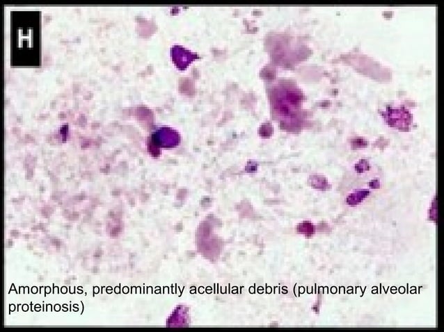 Bal fluid analysis | PPT | Lung and Respiratory Health | Diseases and ...