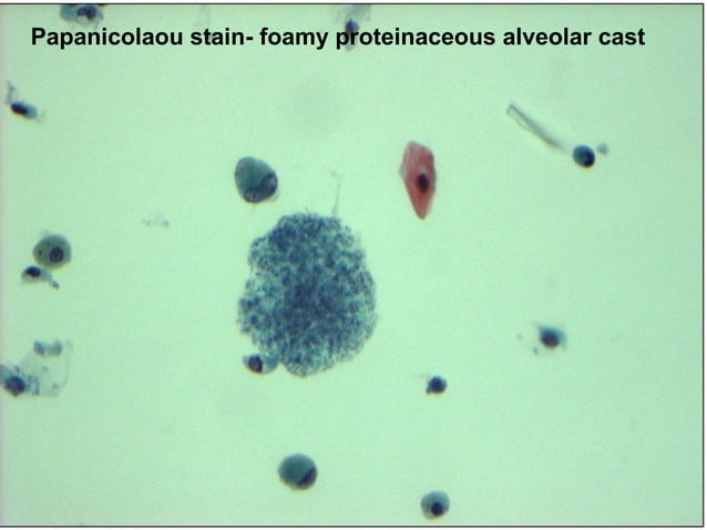 Bal fluid analysis | PPT | Lung and Respiratory Health | Diseases and ...