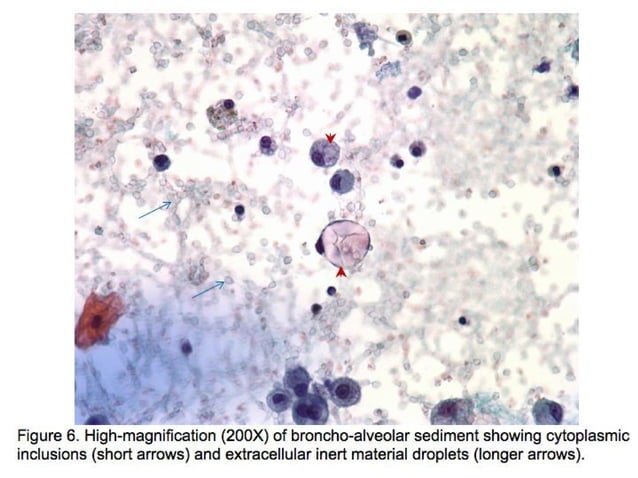 Bal fluid analysis | PPT | Lung and Respiratory Health | Diseases and ...