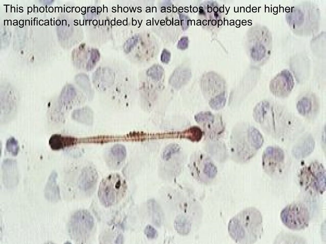 Bal fluid analysis | PPT | Lung and Respiratory Health | Diseases and ...