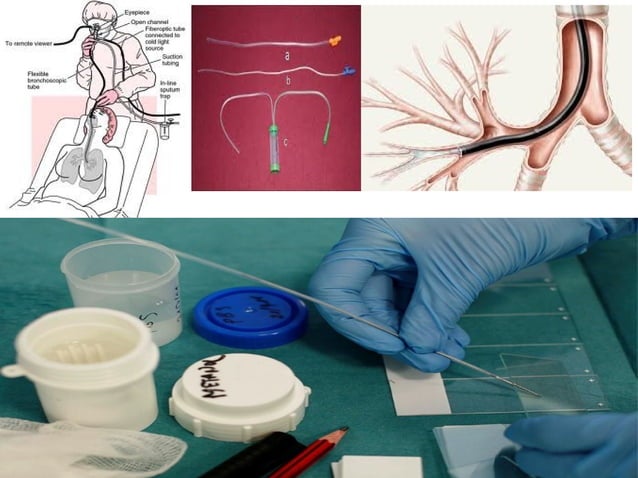 Bal fluid analysis | PPT | Lung and Respiratory Health | Diseases and ...