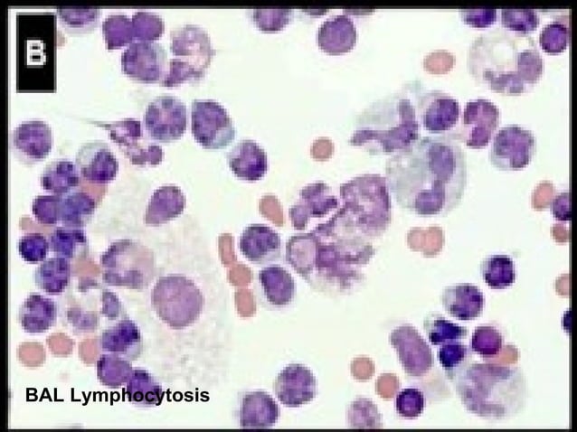 Bal fluid analysis | PPT | Lung and Respiratory Health | Diseases and ...