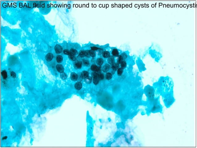Bal fluid analysis | PPT | Lung and Respiratory Health | Diseases and ...