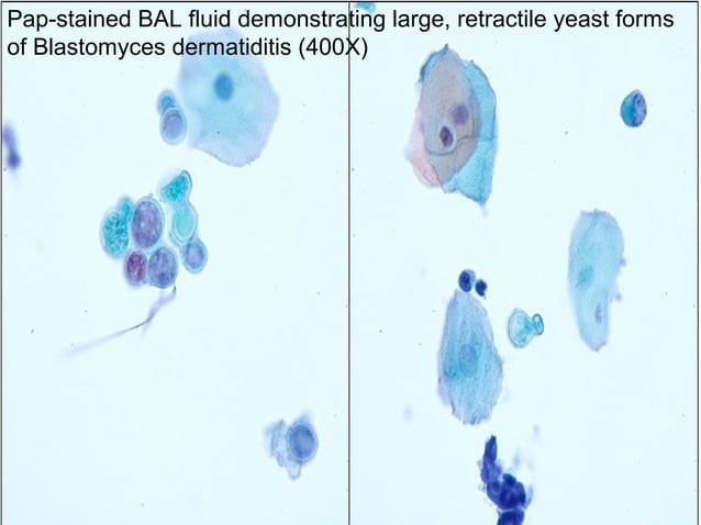 Bal fluid analysis | PPT | Lung and Respiratory Health | Diseases and ...