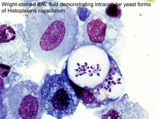 Bal fluid analysis | PPT